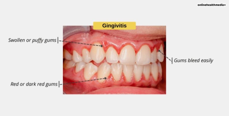 Is Gingivitis Contagious In Humans? | Online Health Media