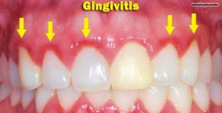 Is Gingivitis Contagious In Humans? | Online Health Media