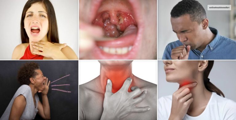 Is Laryngitis Contagious? | Causes, Types, And Symptoms!