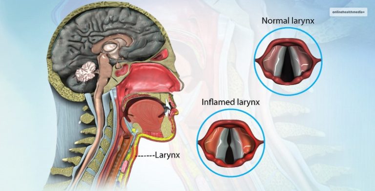 Is Laryngitis Contagious? | Causes, Types, And Symptoms!
