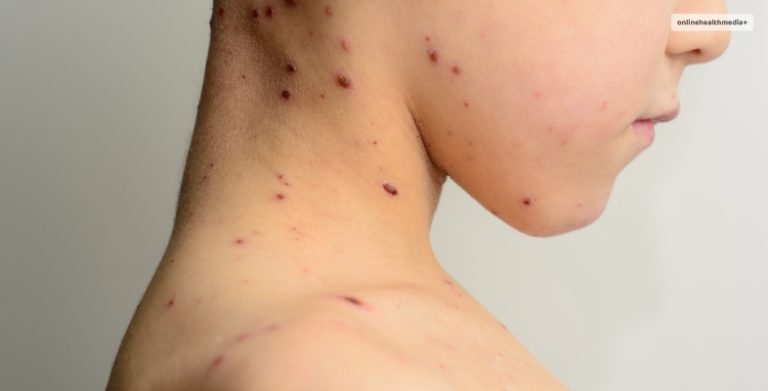 How To Remove Chicken Pox Scars? - Treatment And Skincare Tips