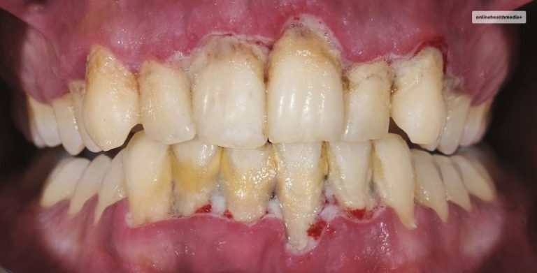 What Does A Cavity Look Like? - All Signs And Symptoms