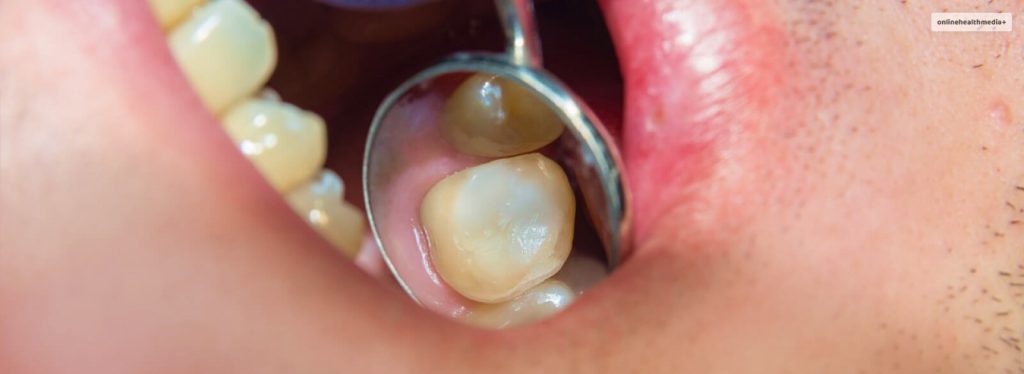 How Long Does A Root Canal Last Without A Crown? - [Dental Guide]