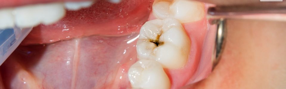 What Does A Cavity Look Like? - All Signs And Symptoms