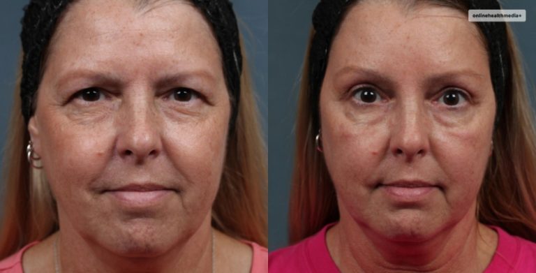 Botox Before And After : What Changes And What To Keep In Mind!