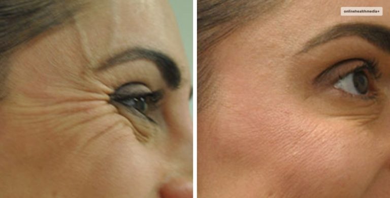 Botox Before And After : What Changes And What To Keep In Mind!
