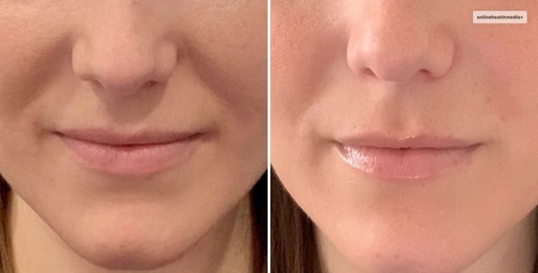 Botox Danger Zones: Facial Zones That You Need To Avoid Injecting!