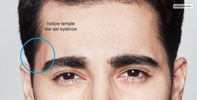 Botox Danger Zones: Facial Zones That You Need To Avoid Injecting!