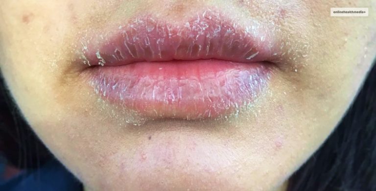 Eczema On Lips: Types, Causes, Symptoms, Treatment, And More!