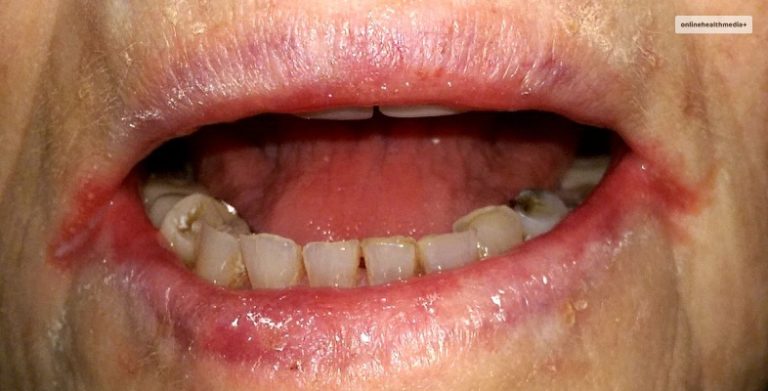 Eczema On Lips: Types, Causes, Symptoms, Treatment, And More!