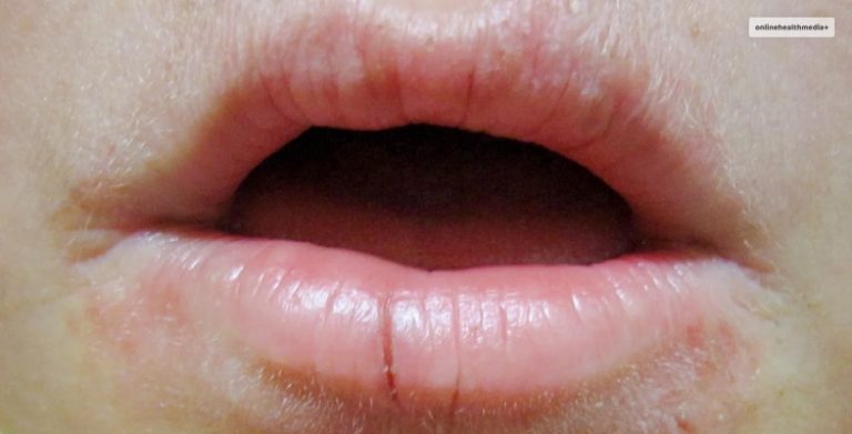 Eczema On Lips: Types, Causes, Symptoms, Treatment, And More!