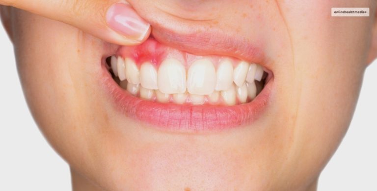 How To Treat Burned Gums From Teeth Whitening?