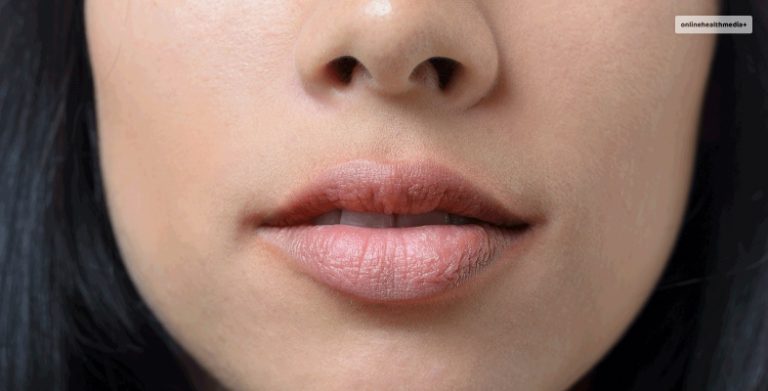 Eczema On Lips: Types, Causes, Symptoms, Treatment, And More!