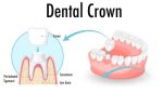 Tooth Cap Vs. Crown: What's The Difference And Which Is Best For You?