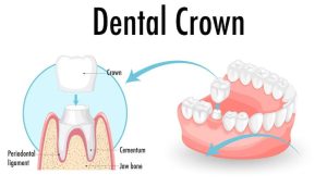 Tooth Cap Vs. Crown: What's The Difference And Which Is Best For You?