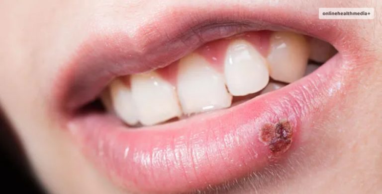Skin lesions 101: Everything you need to know!