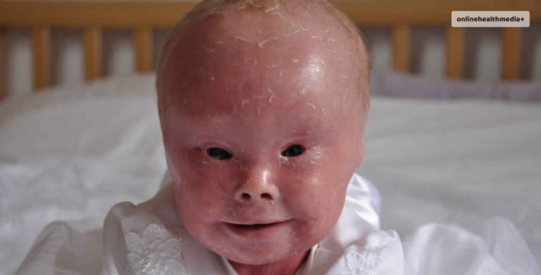 Harlequin ichthyosis 101: Everything you need to know about it!