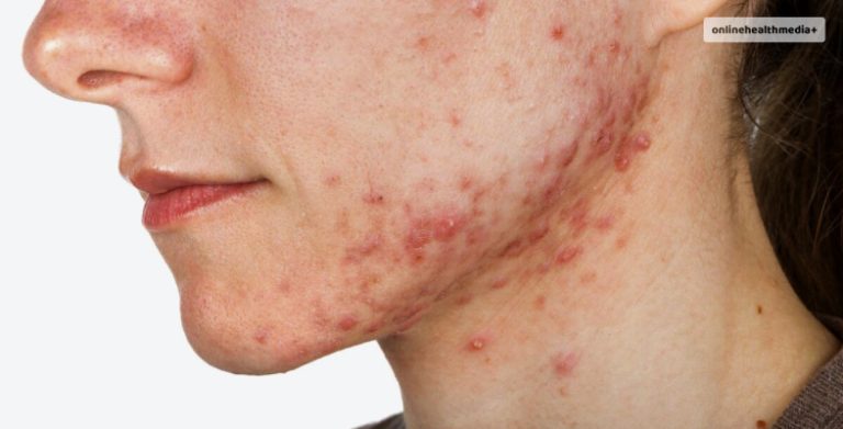 Nodular Acne: How To Get Rid Of Those Stubborn Nodes Under Your Skin