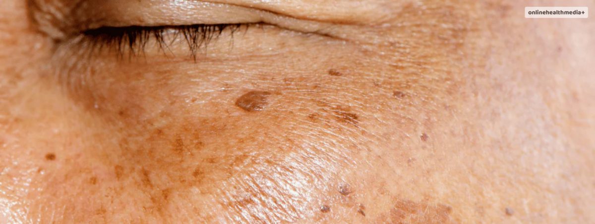 Sun-Kissed Souvenirs: Embracing Your Skin's Story with a Guide to Liver ...