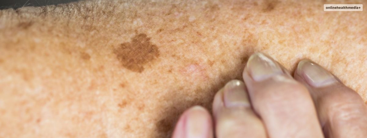Melanoma Liver Spot - Here Is What You Should Know