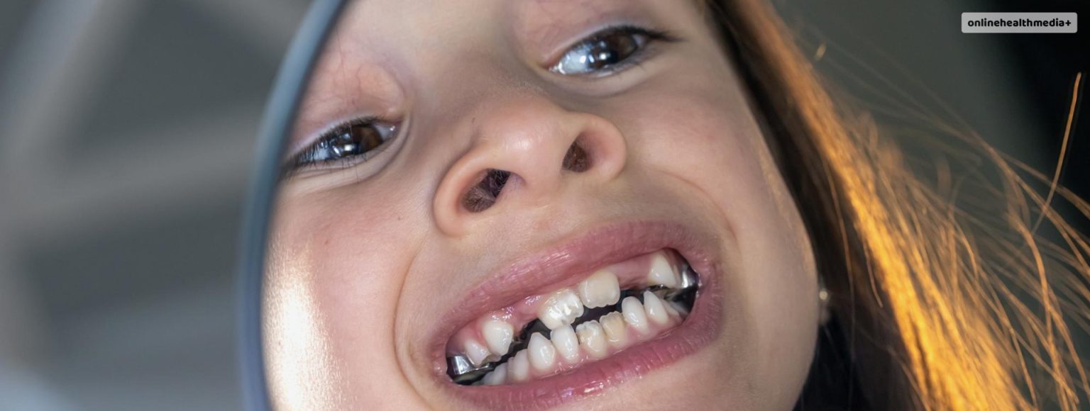 Buck Teeth: Bugs Bunny Syndrome Or A Serious Issue?