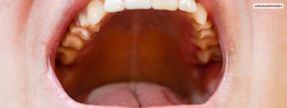 Torus Palatinus: Understanding The Condition With Case Report.