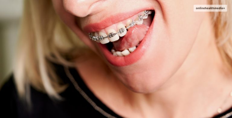 Buck Teeth: Bugs Bunny Syndrome Or A Serious Issue?