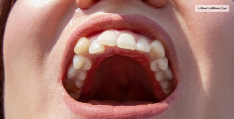 Torus Palatinus: Understanding The Condition With Case Report.